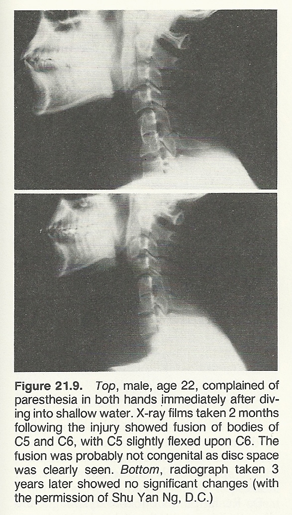 Flexion Injuries. During forceful cervical flexion, a unilateral facet ...