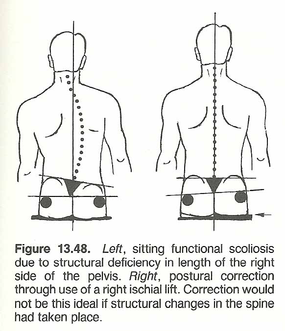Biomechanical Considerations in the Therapy of Thoracic Scoliosis