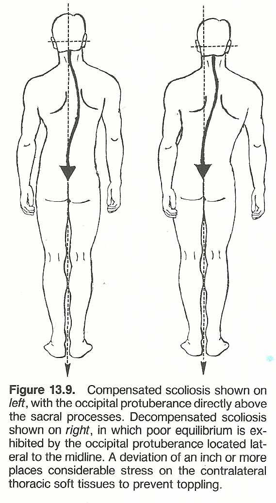 Types of Scoliosis Classifications