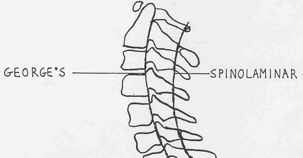 George's Line (or the Posterior Body Line) is a curved line that should ...